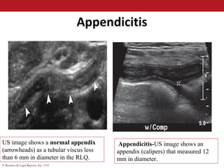 Acute abdomen dr.lalitha | PPT