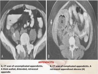 ACUTE ABDOMENAL PAIN.pptx
