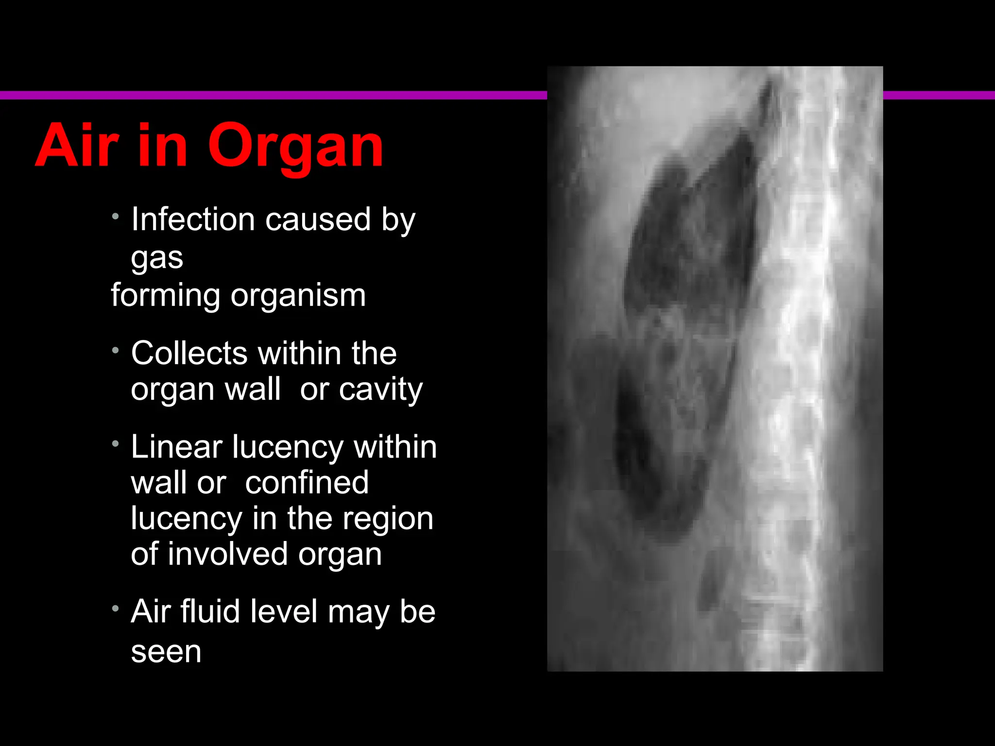 acute abdomen and imaging in trauma ug.ppt