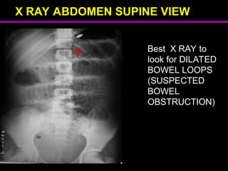 acute abdomen and imaging in trauma ug.ppt