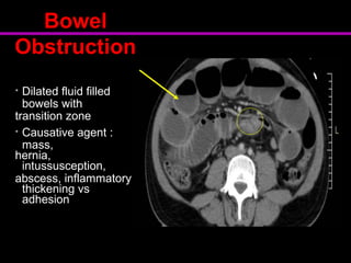 acute abdomen and imaging in trauma ug.ppt