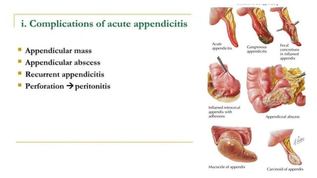 ACUTE ABDOMEN appendicitis AND peritonitis eden 2024.pptx