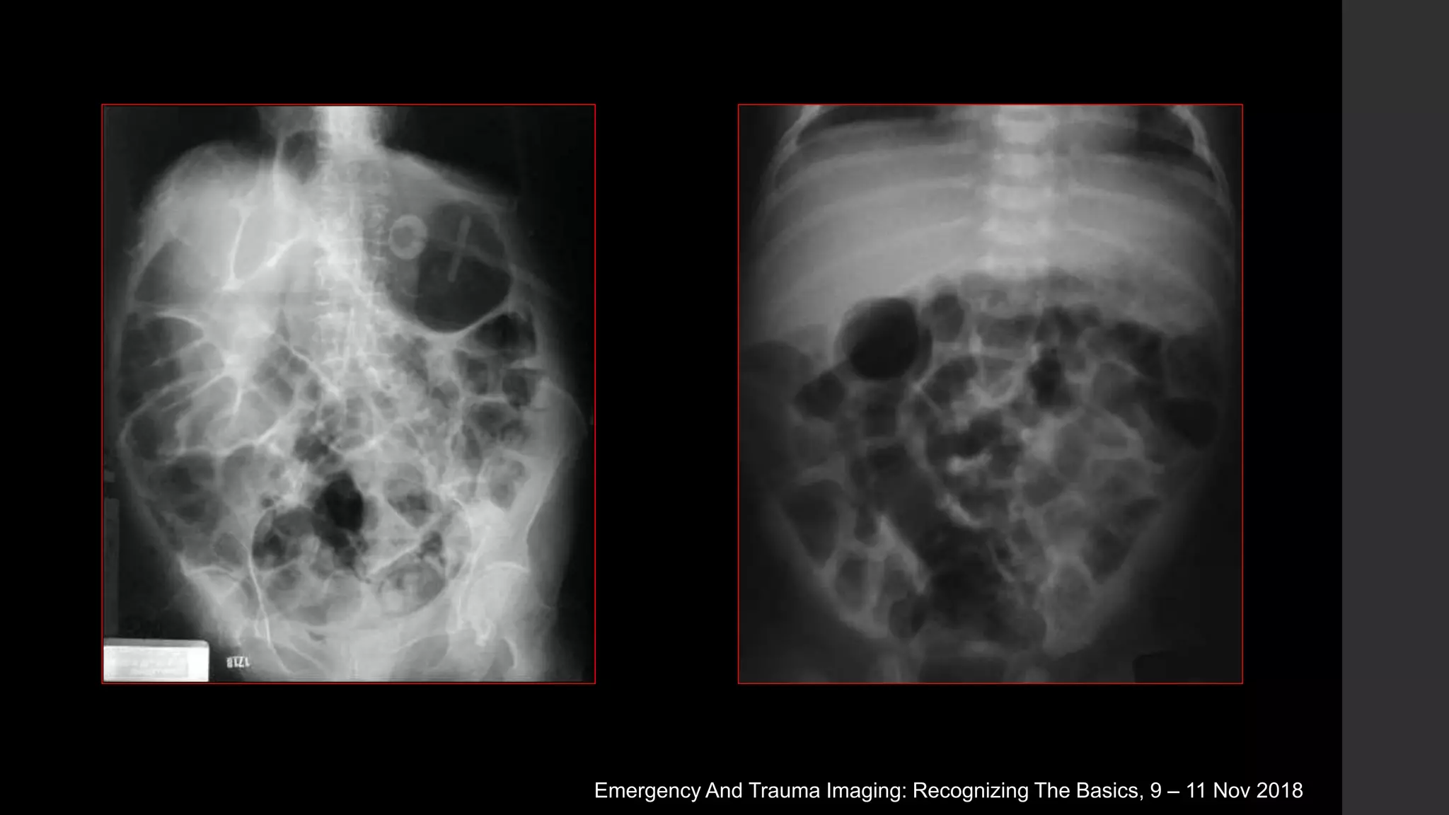 Acute Abdomen Imaging | PPTX