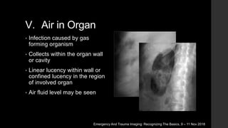 Acute Abdomen Imaging | PPTX
