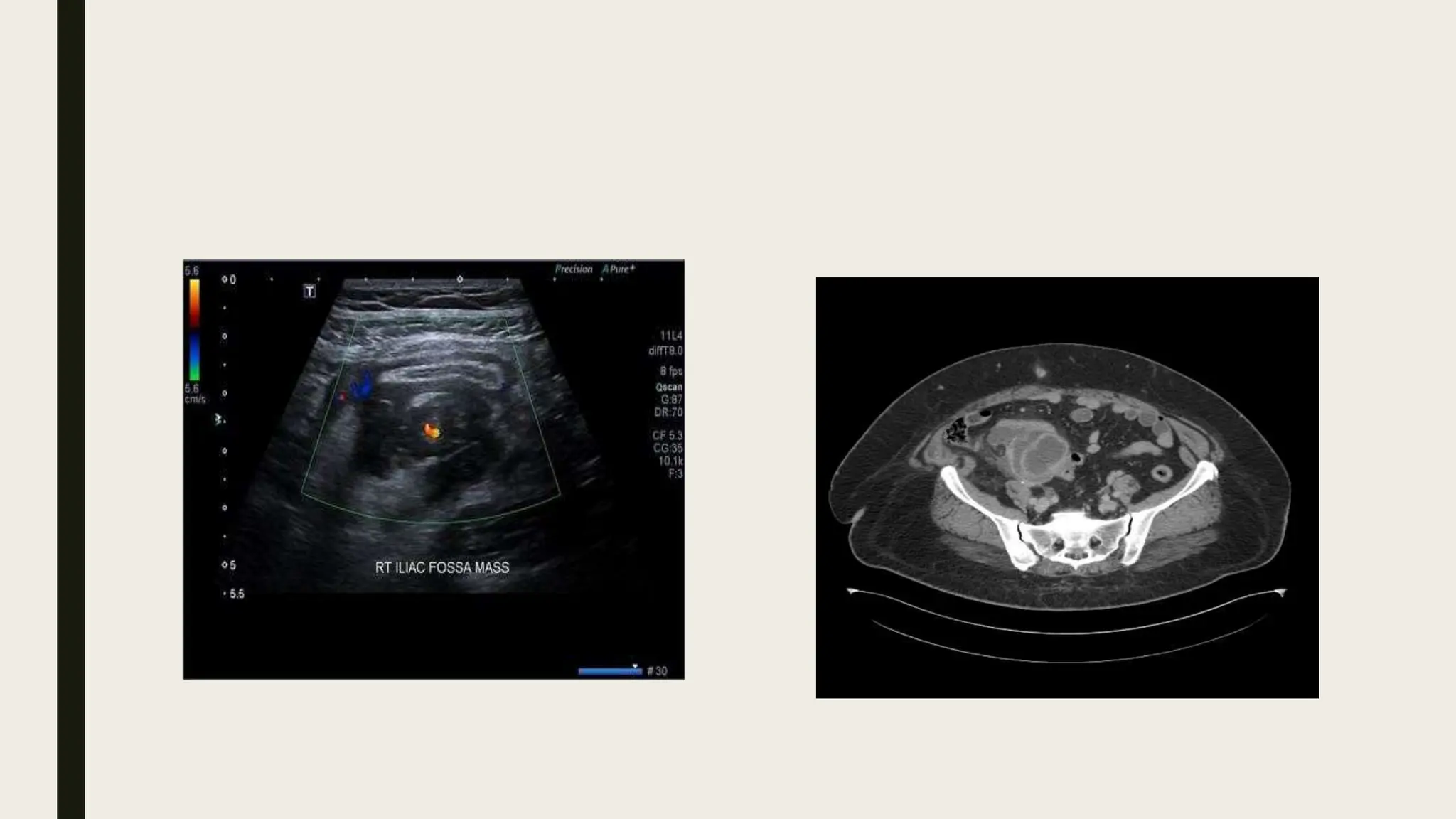 ACUTE ABDOMEN IMAGING 2.pptxACUTE ABDOMEN IMAGING 2.pptxACUTE ABDOMEN ...
