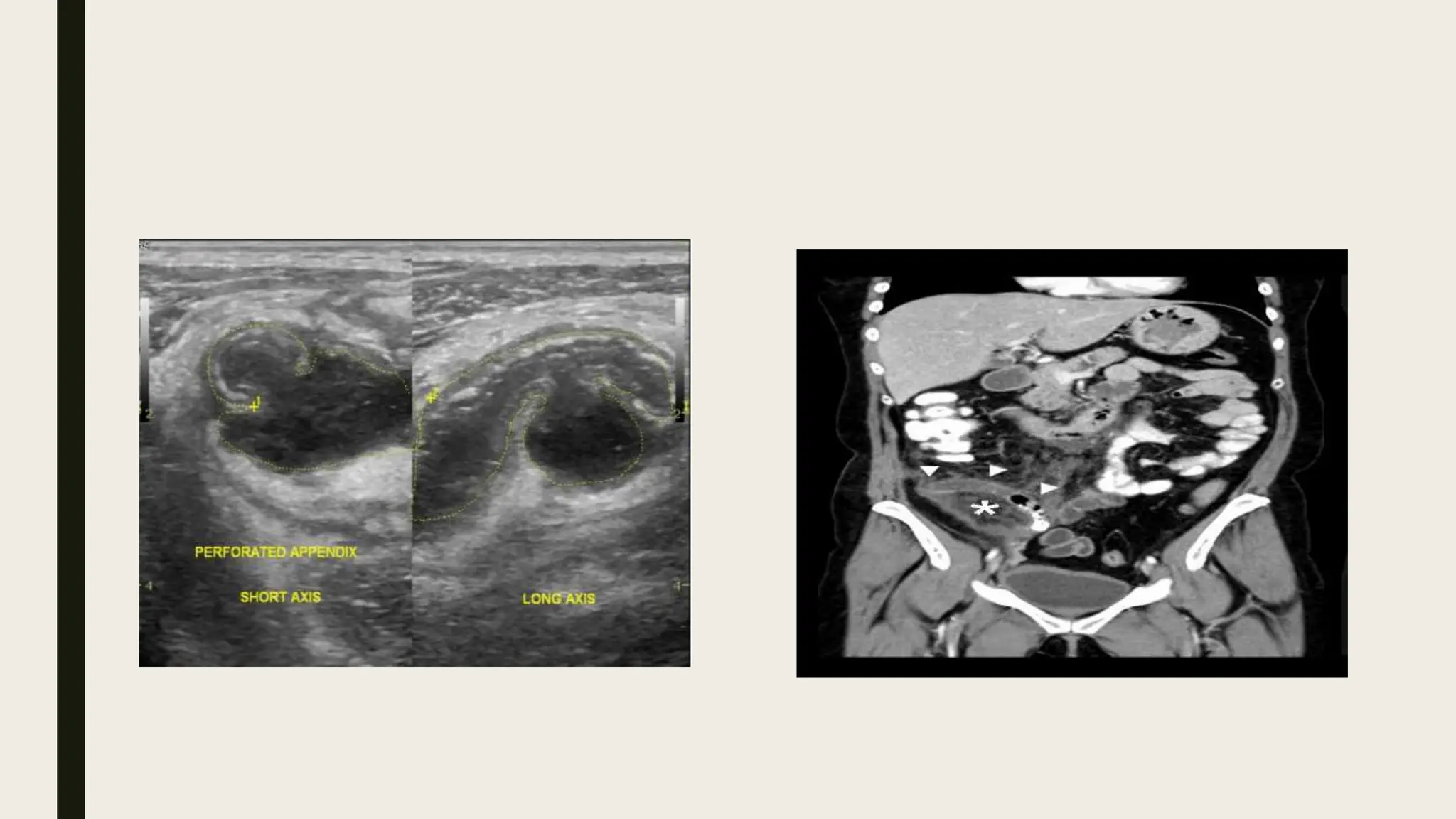 ACUTE ABDOMEN IMAGING 2.pptxACUTE ABDOMEN IMAGING 2.pptxACUTE ABDOMEN ...