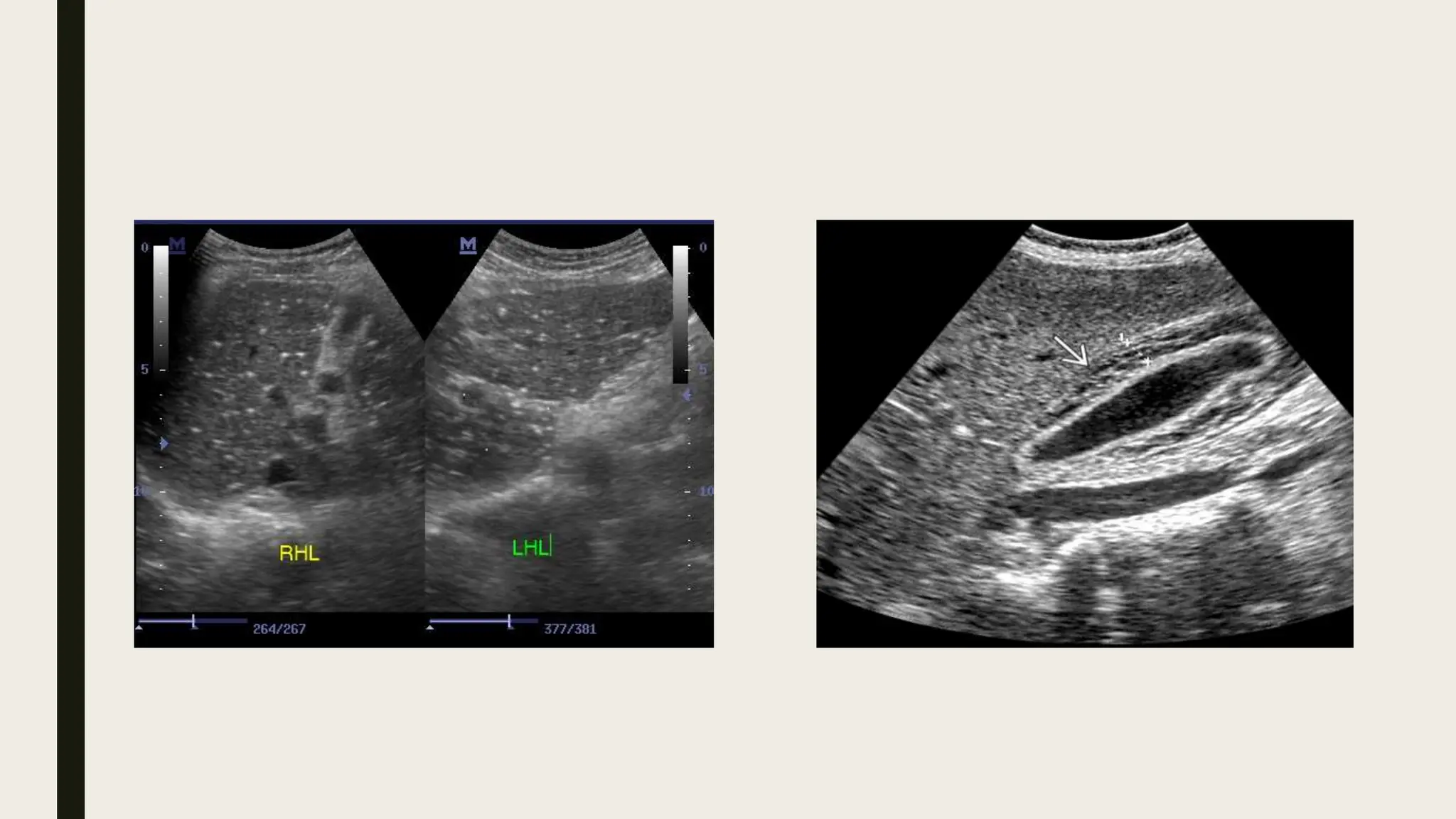 ACUTE ABDOMEN IMAGING 2.pptxACUTE ABDOMEN IMAGING 2.pptxACUTE ABDOMEN ...