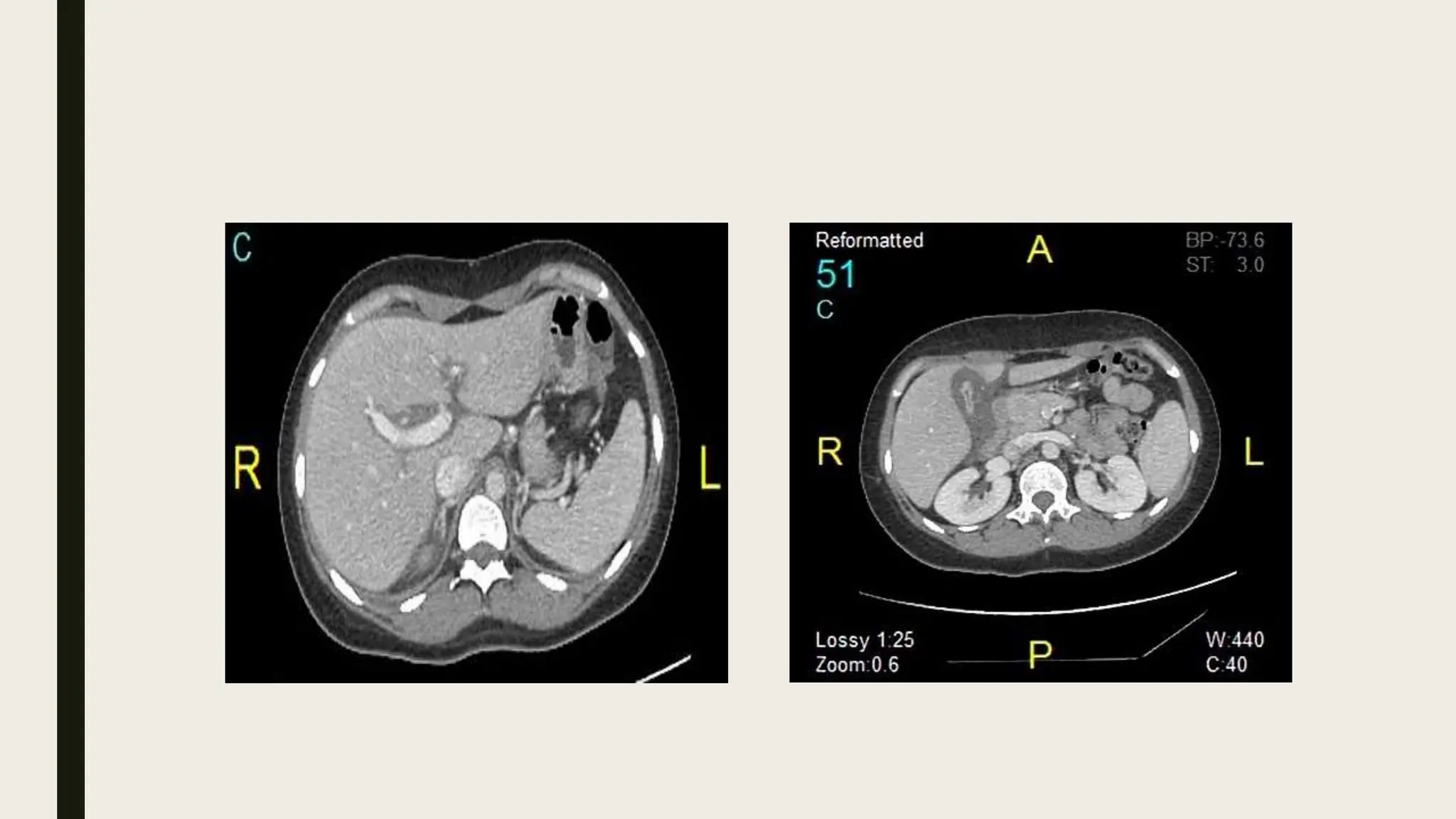 ACUTE ABDOMEN IMAGING 2.pptxACUTE ABDOMEN IMAGING 2.pptxACUTE ABDOMEN IMAGING 2.pptx