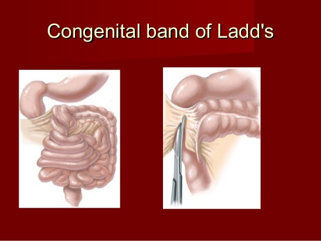 Acute abdomen in_pediatric