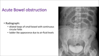 Acute Abdomen | PDF