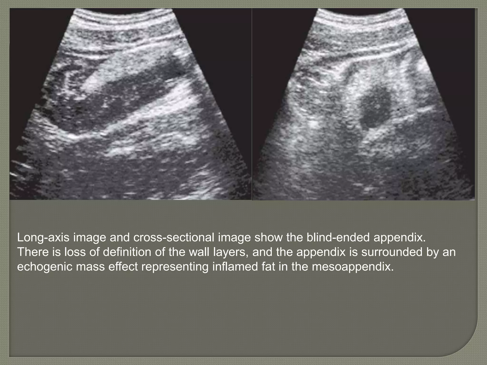 ACUTE ABDOMEN SONOGRAPHIC FINDINGS ppt | PPTX | Pregnancy ...