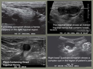ACUTE ABDOMEN SONOGRAPHIC FINDINGS ppt | PPTX