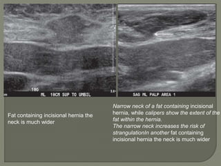 ACUTE ABDOMEN SONOGRAPHIC FINDINGS ppt | PPTX