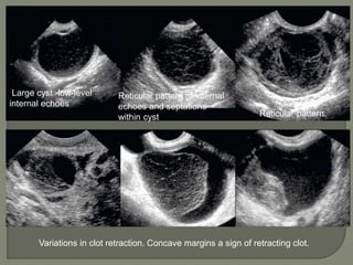 ACUTE ABDOMEN SONOGRAPHIC FINDINGS ppt | PPTX