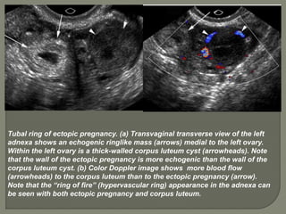 ACUTE ABDOMEN SONOGRAPHIC FINDINGS ppt | PPTX