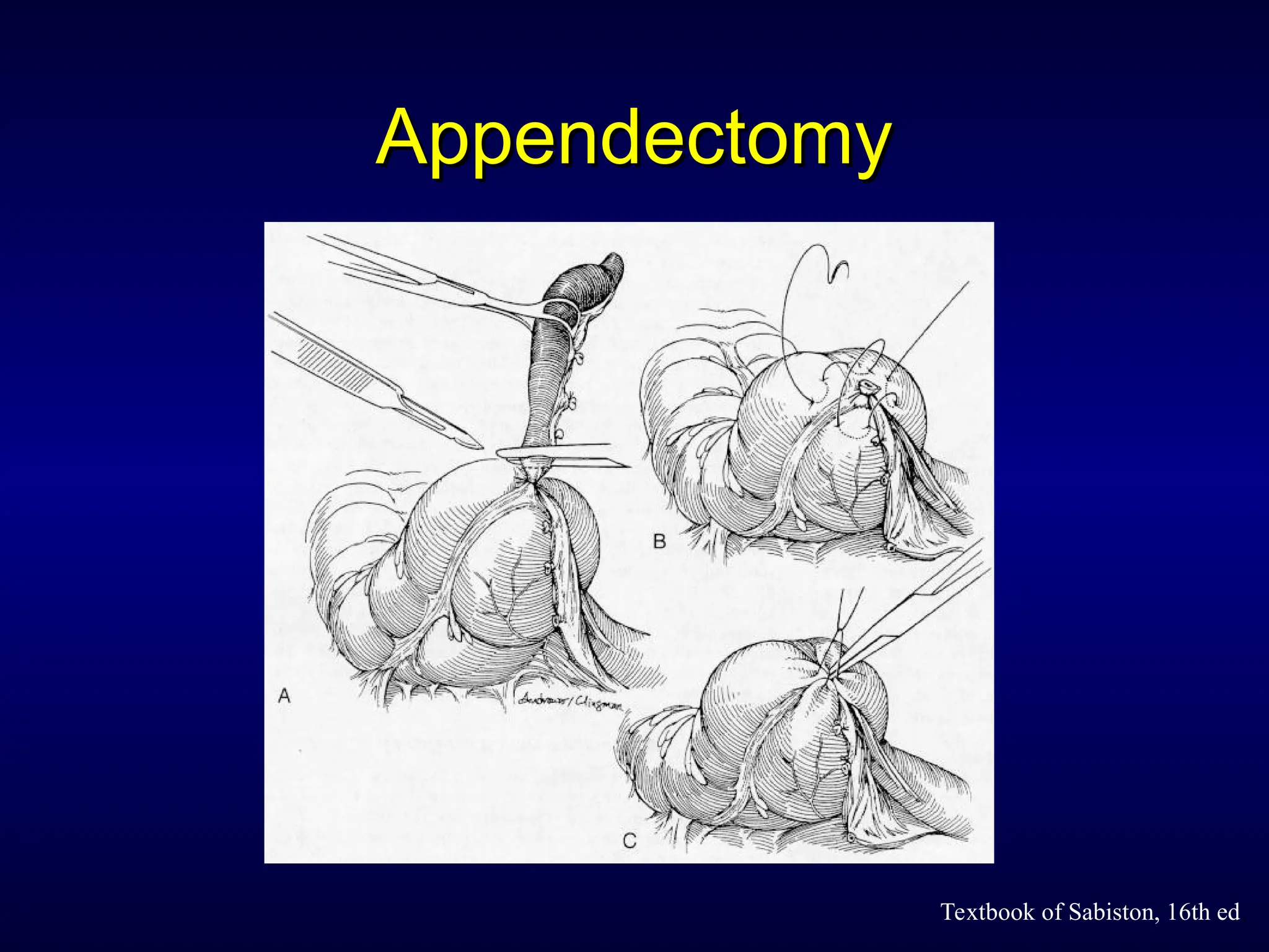 ACUTE ADOMEN AND APPENDICITIS for Surgery.ppt