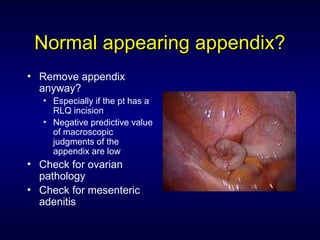 ACUTE ADOMEN AND APPENDICITIS for Surgery.ppt