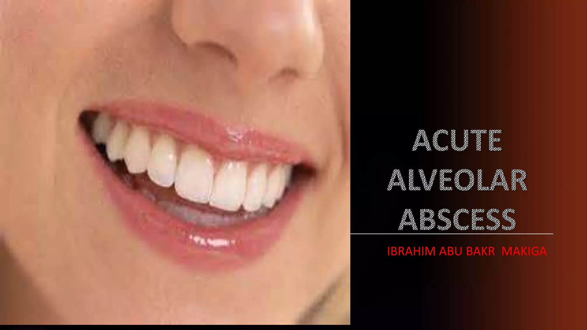 Acute alveolar abscess | PPTX