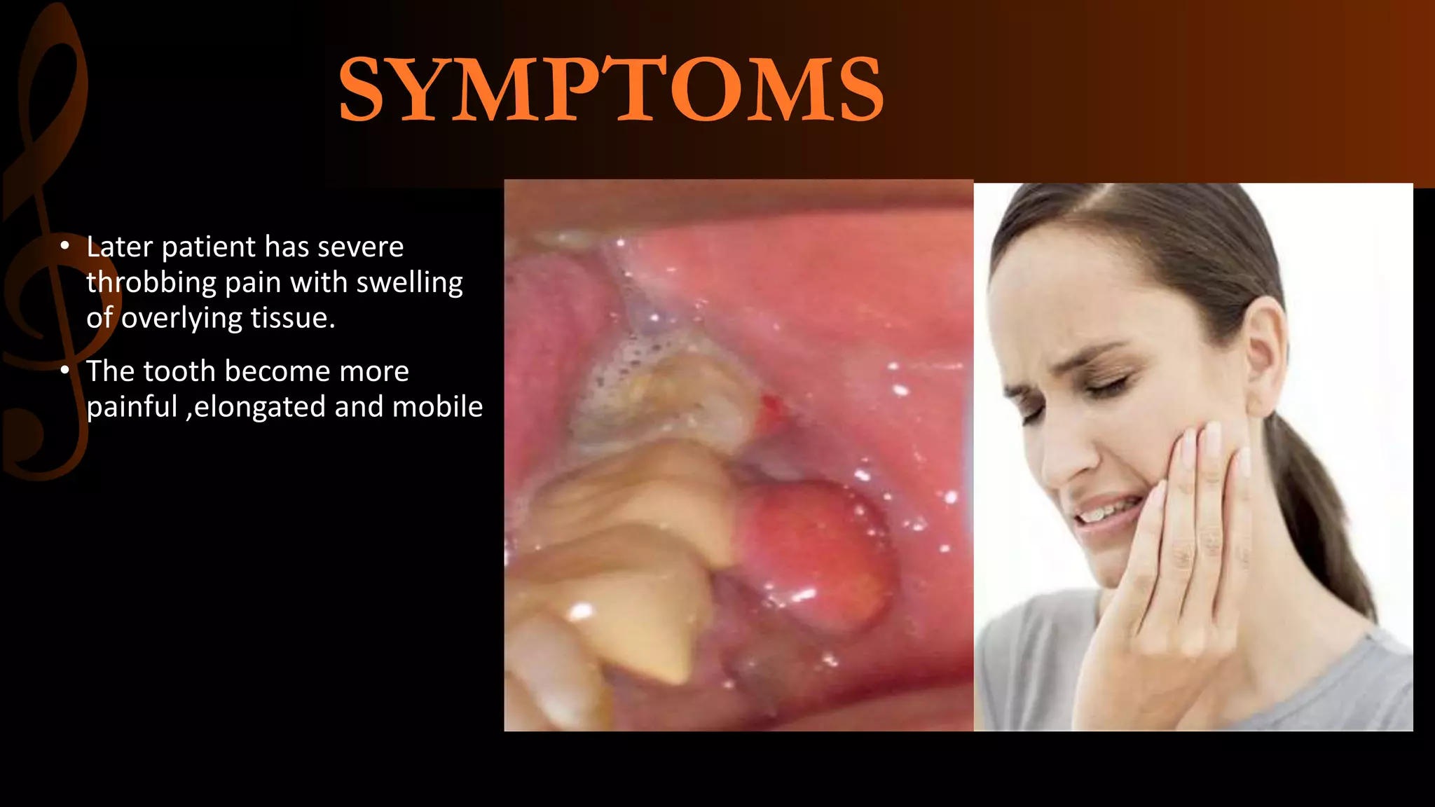 Acute alveolar abscess | PPTX