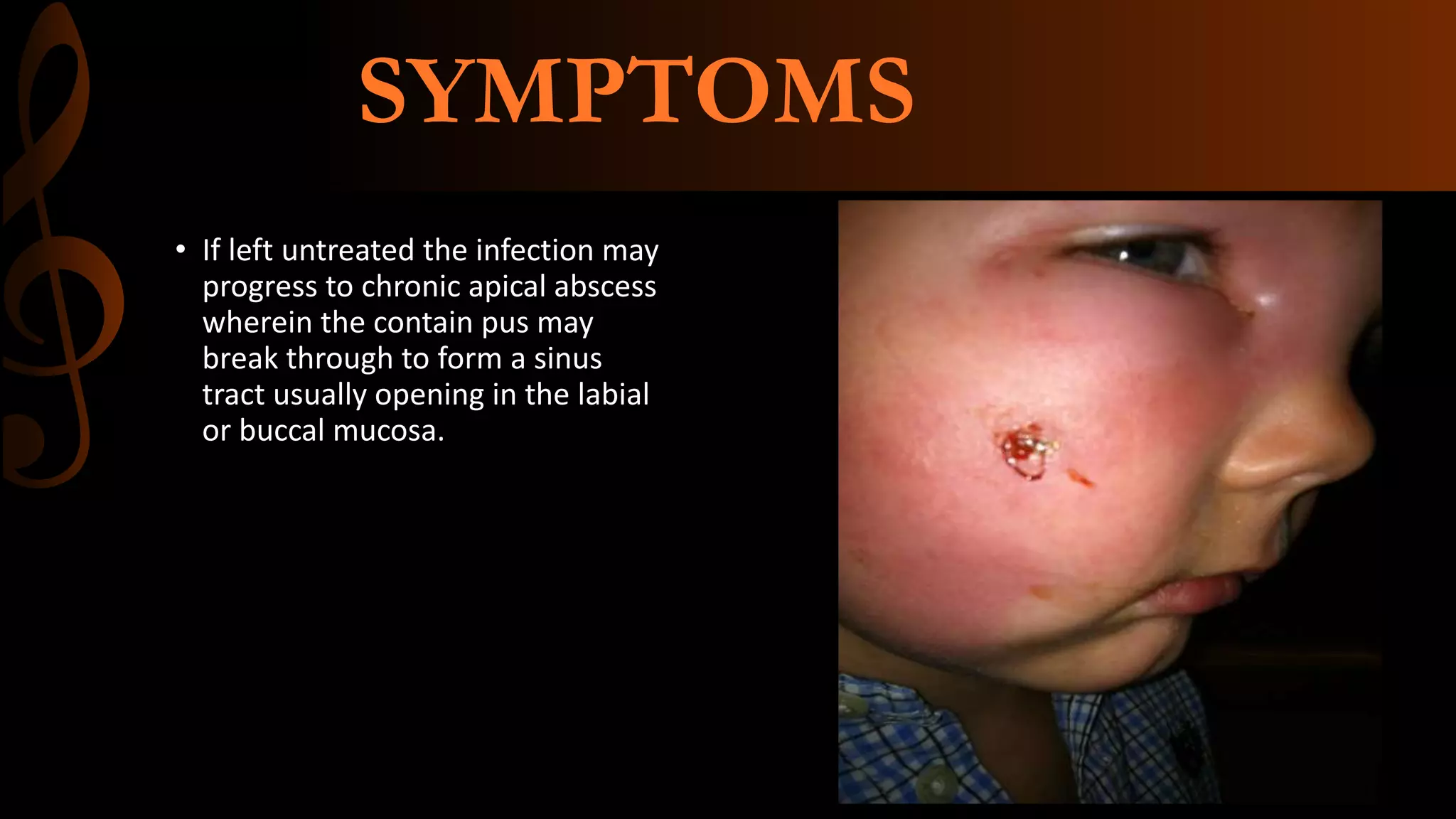 Acute alveolar abscess | PPTX