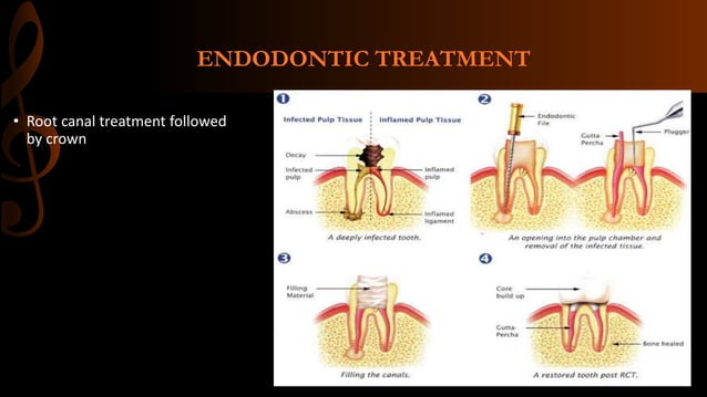 Acute alveolar abscess | PPTX