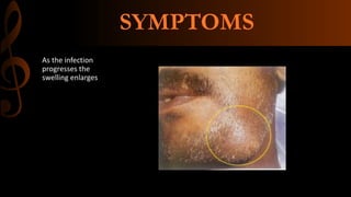 Acute alveolar abscess | PPTX