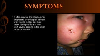 Acute alveolar abscess | PPTX