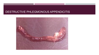 acute and chronic appendicitis presentation .ppt