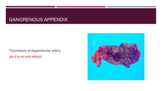 acute and chronic appendicitis presentation .ppt