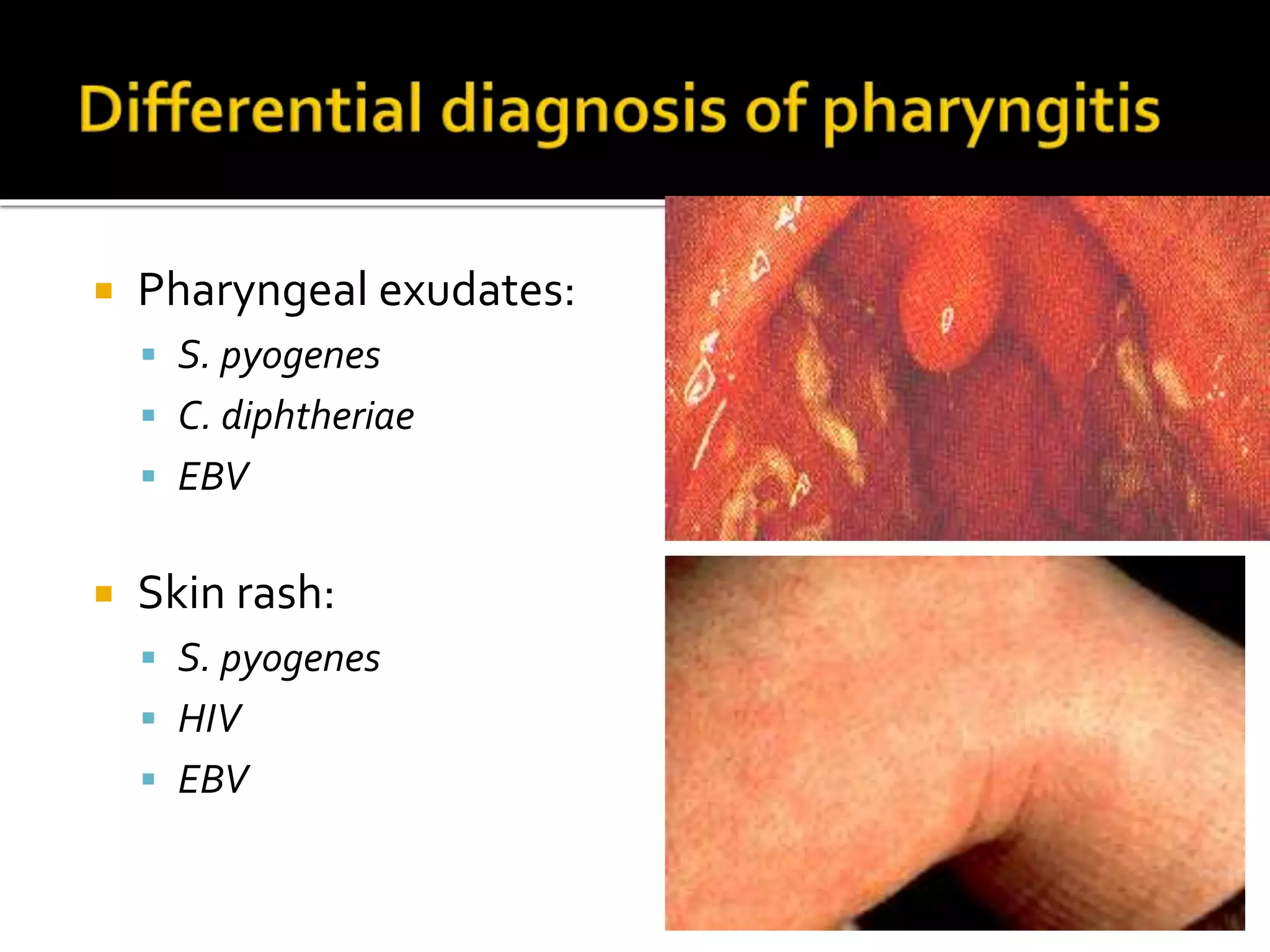 ACUTE AND CHRONIC CONDITION OF PHARYNX & LARYNX.ppt