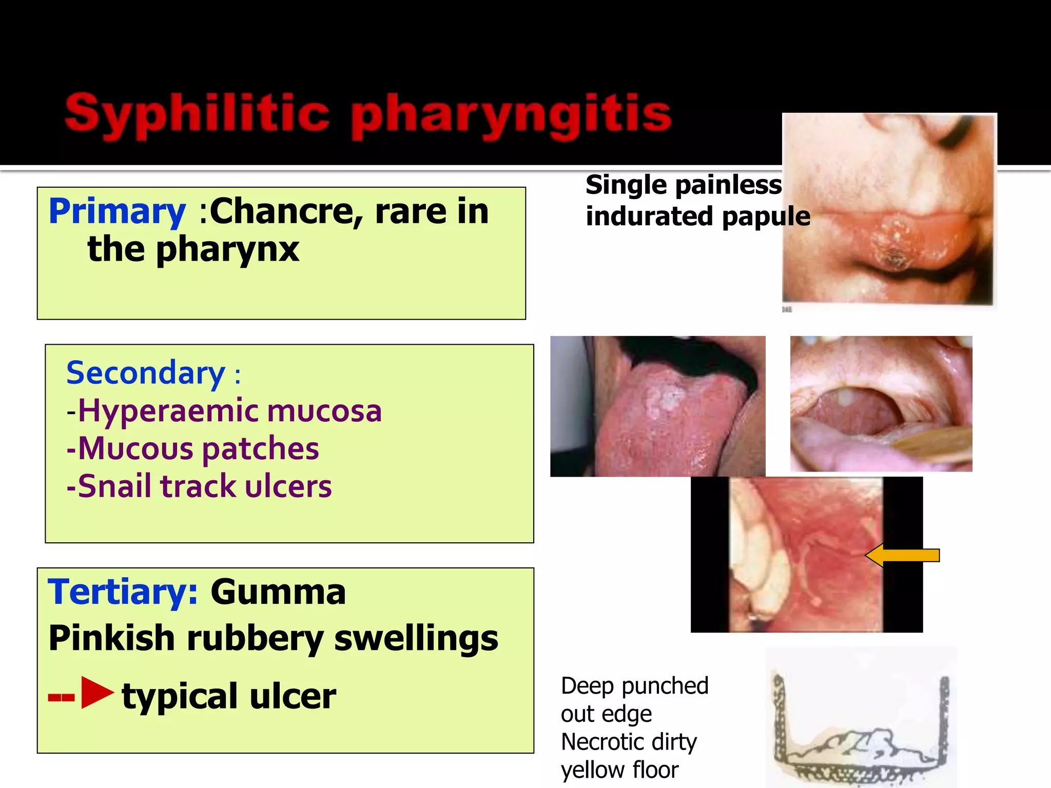 ACUTE AND CHRONIC CONDITION OF PHARYNX & LARYNX.ppt