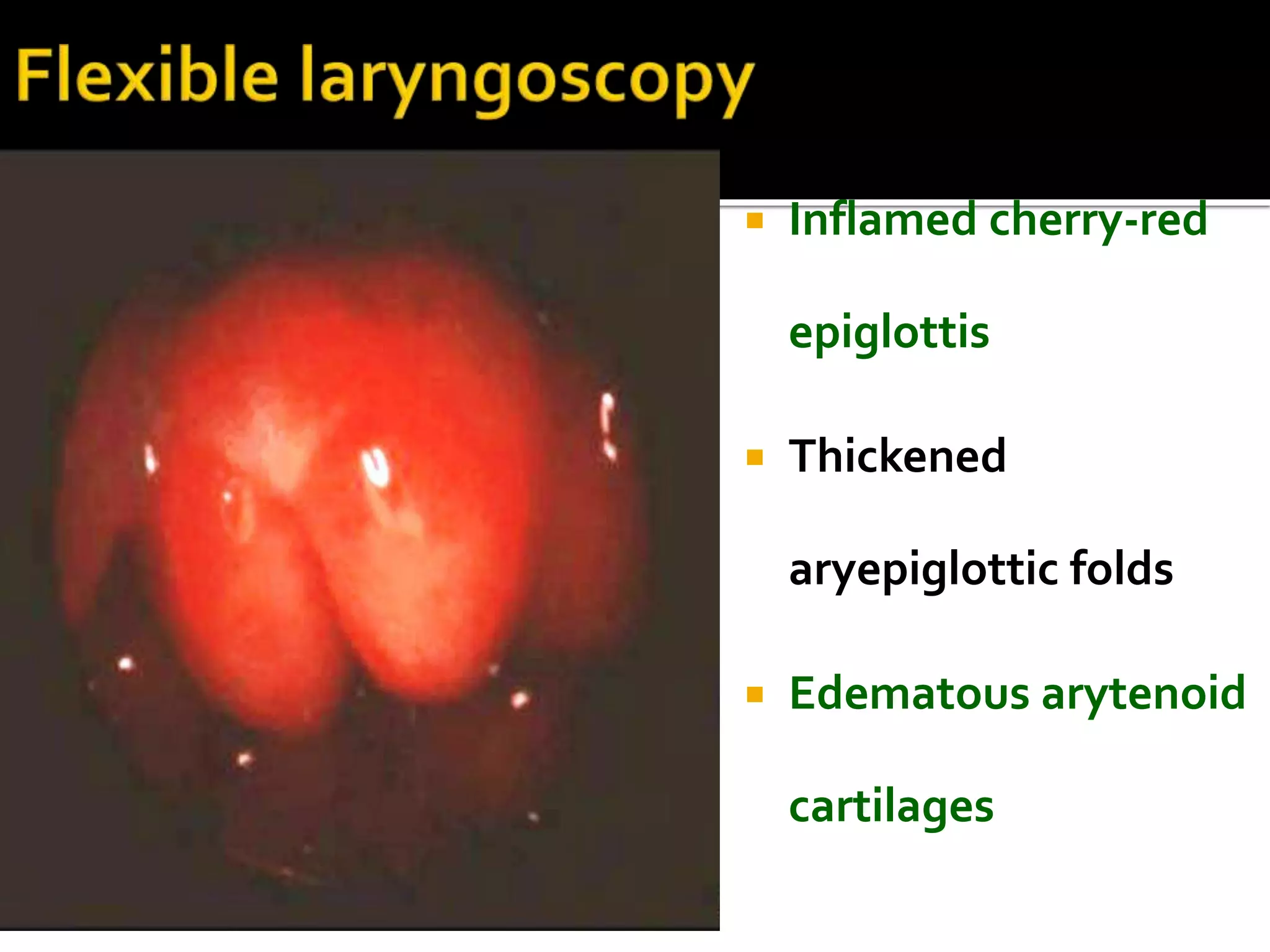 ACUTE AND CHRONIC CONDITION OF PHARYNX & LARYNX.ppt