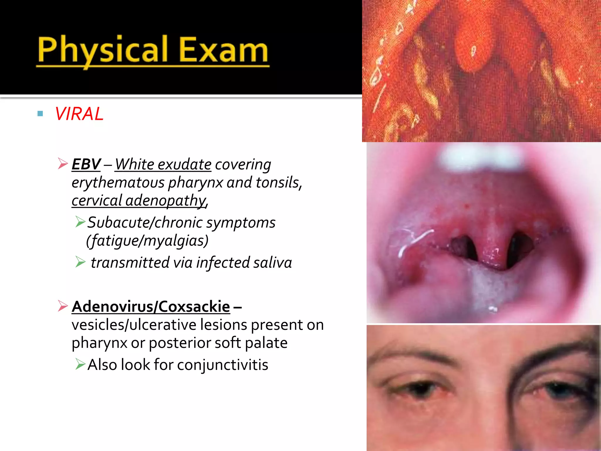 ACUTE AND CHRONIC CONDITION OF PHARYNX & LARYNX.ppt
