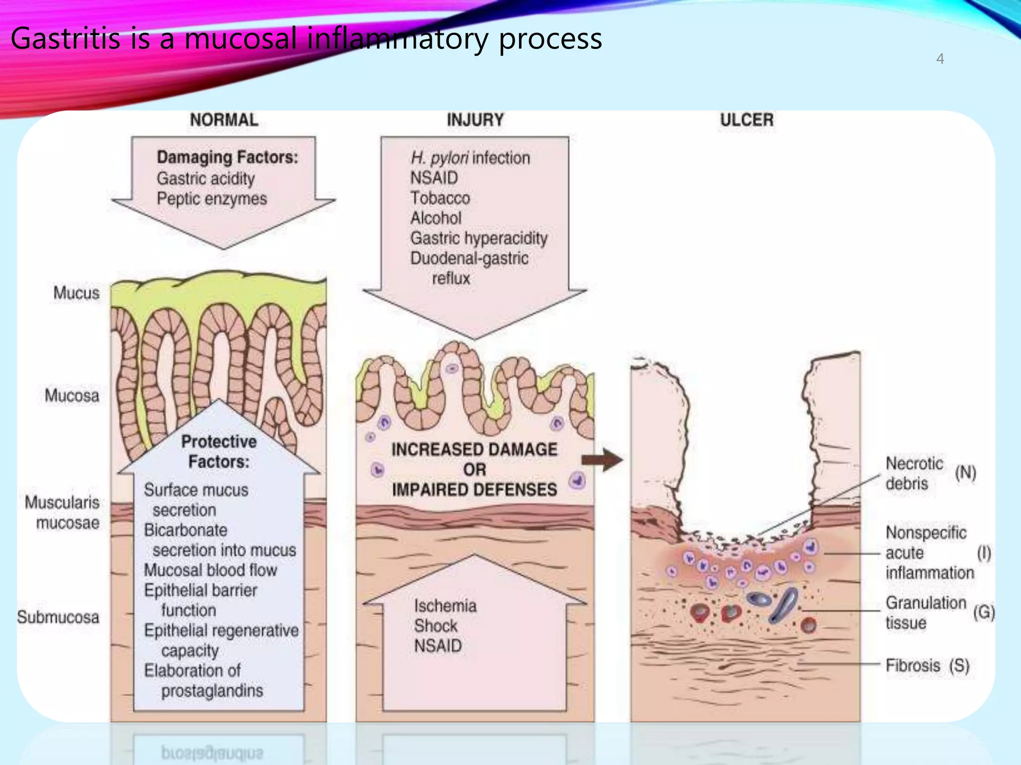 Acute and Chronic gastritis | PPTX