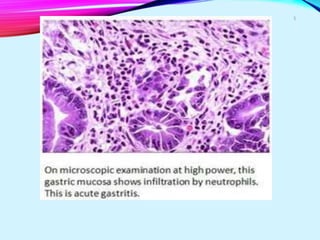 Acute and Chronic gastritis | PPTX