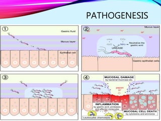 Acute and Chronic gastritis | PPTX