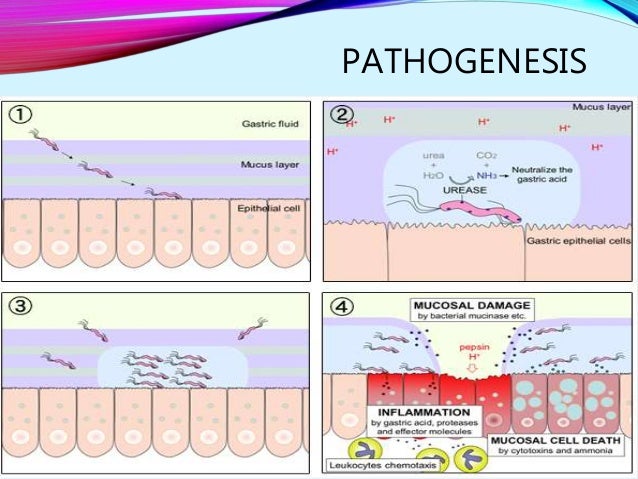 Acute and Chronic gastritis