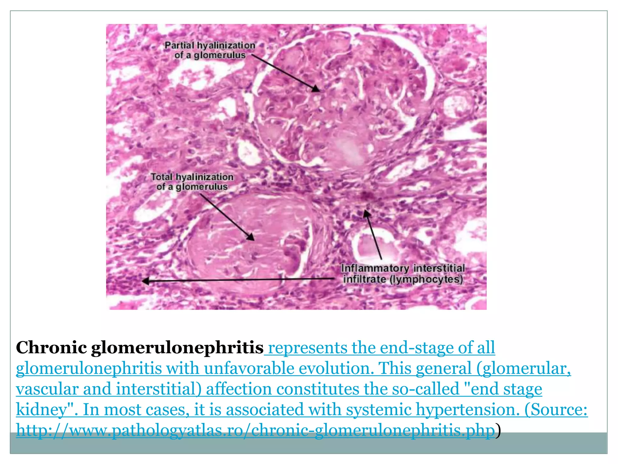 Acute and chronic glomerulonephritis | PPT