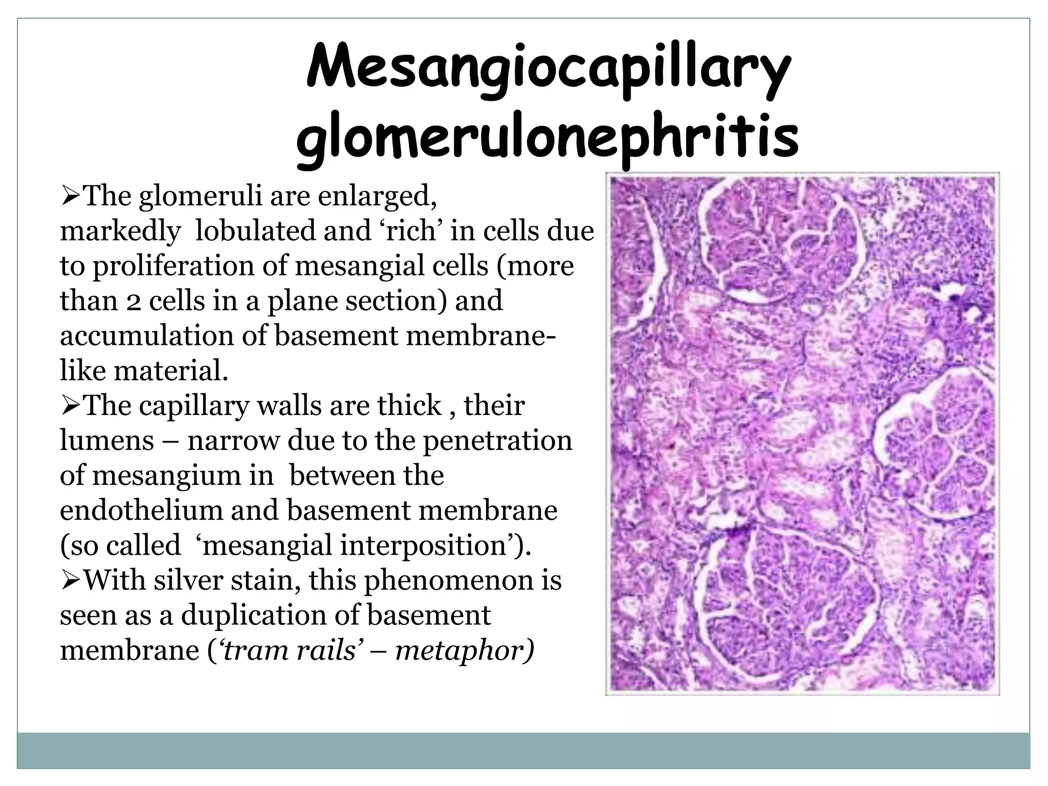 Acute And Chronic Glomerulonephritis Ppt