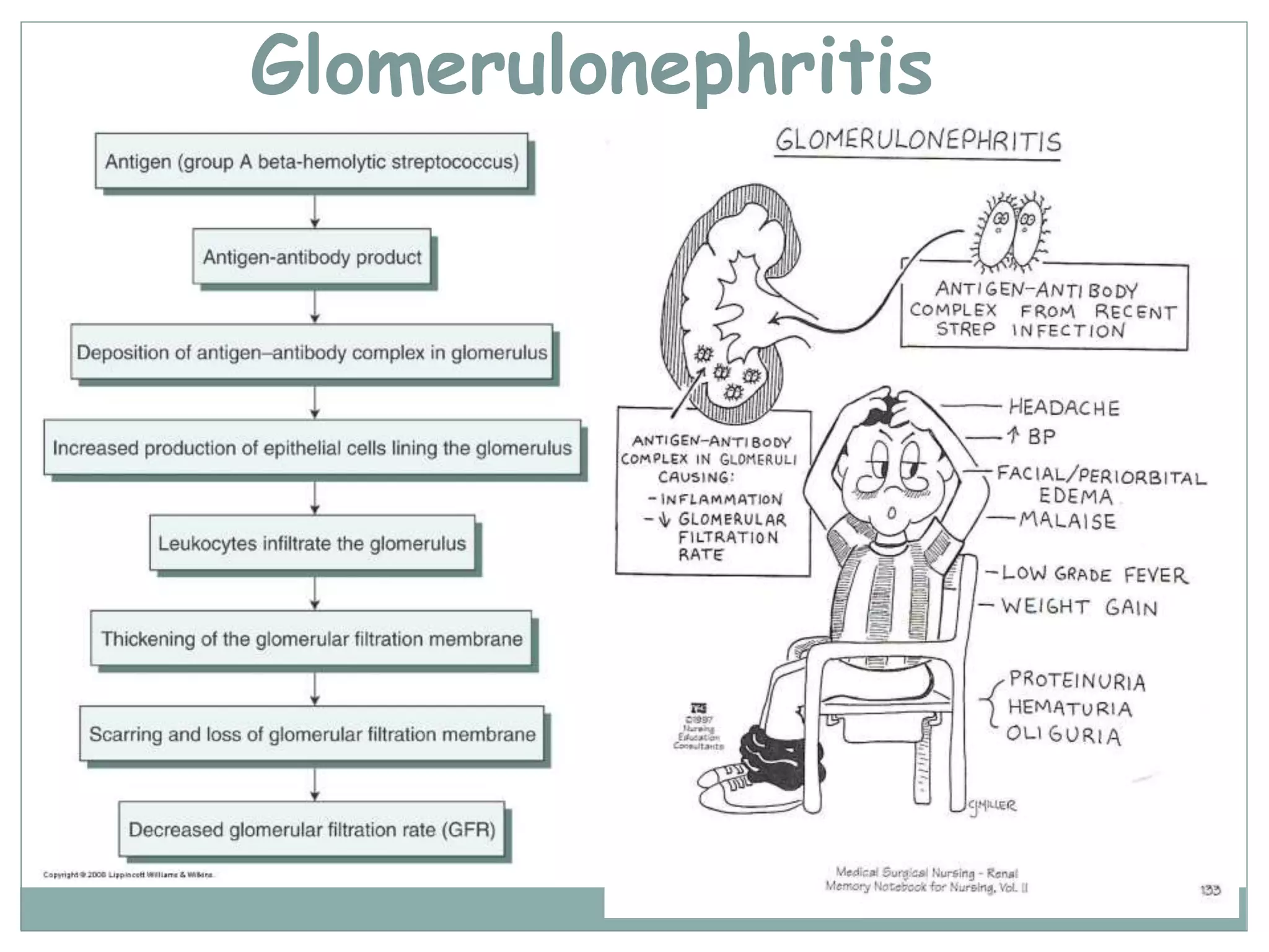 Acute and chronic glomerulonephritis | PPT