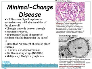 Acute and chronic glomerulonephritis | PPT