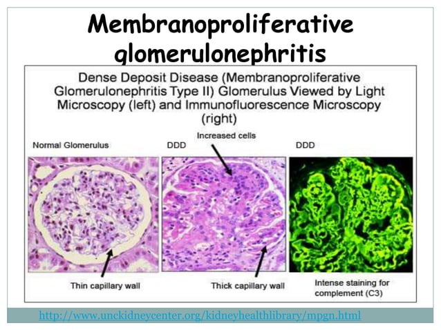 Acute and chronic glomerulonephritis | PPT