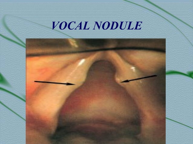 Acute and chronic inflammations of larynx | PPT | Ear, Nose and Throat ...