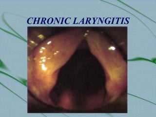 Chronic Laryngitis
