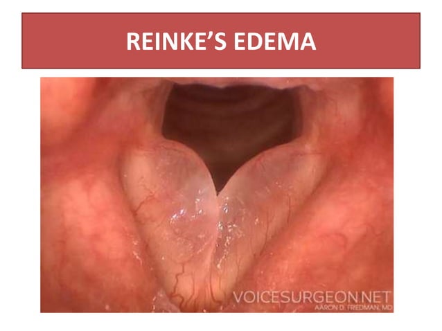 Acute and chronic inflammations of larynx | PPT