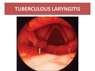 Acute and chronic inflammations of larynx | PPT