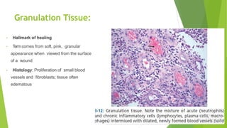 Acute and Chronic inflammation & Wound Healing | PPTX | Blood Disorders ...