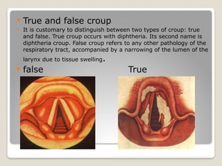 ACUTE AND CHRONIC INFLAMMATORY DISEASES OF THE LARRYNGE.pptx