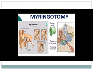 Acute and Chronic Mastoiditis. serious health problem | PPTX