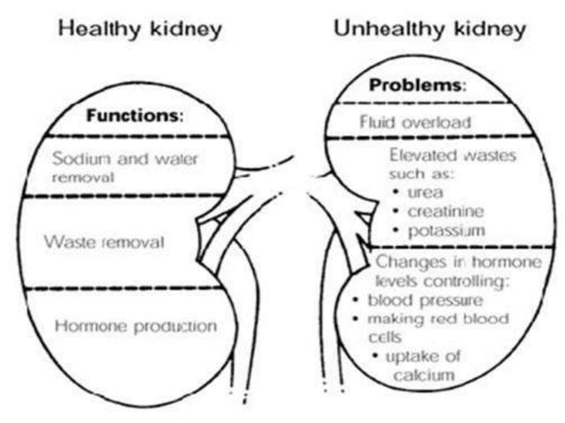 Acute and chronic renal failuree | PPTX | Blood Disorders | Diseases ...